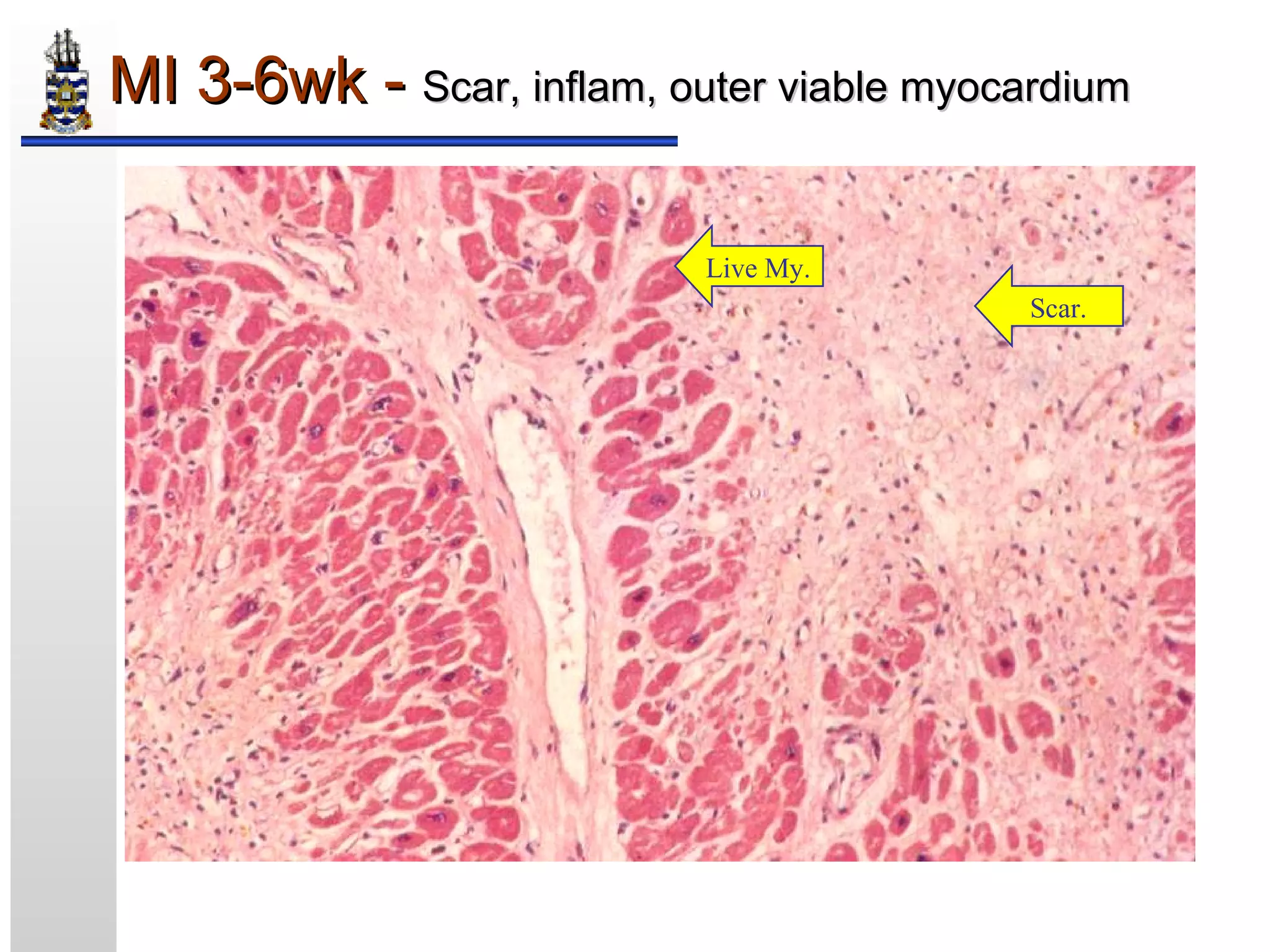 Pathology of Myocardial Infarction | PPT