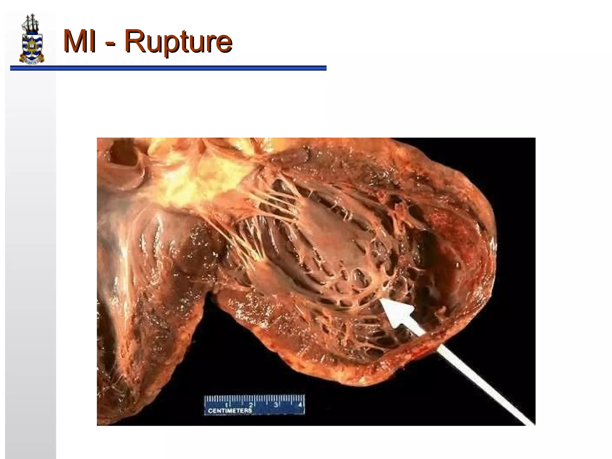 Pathology of Myocardial Infarction | PPT