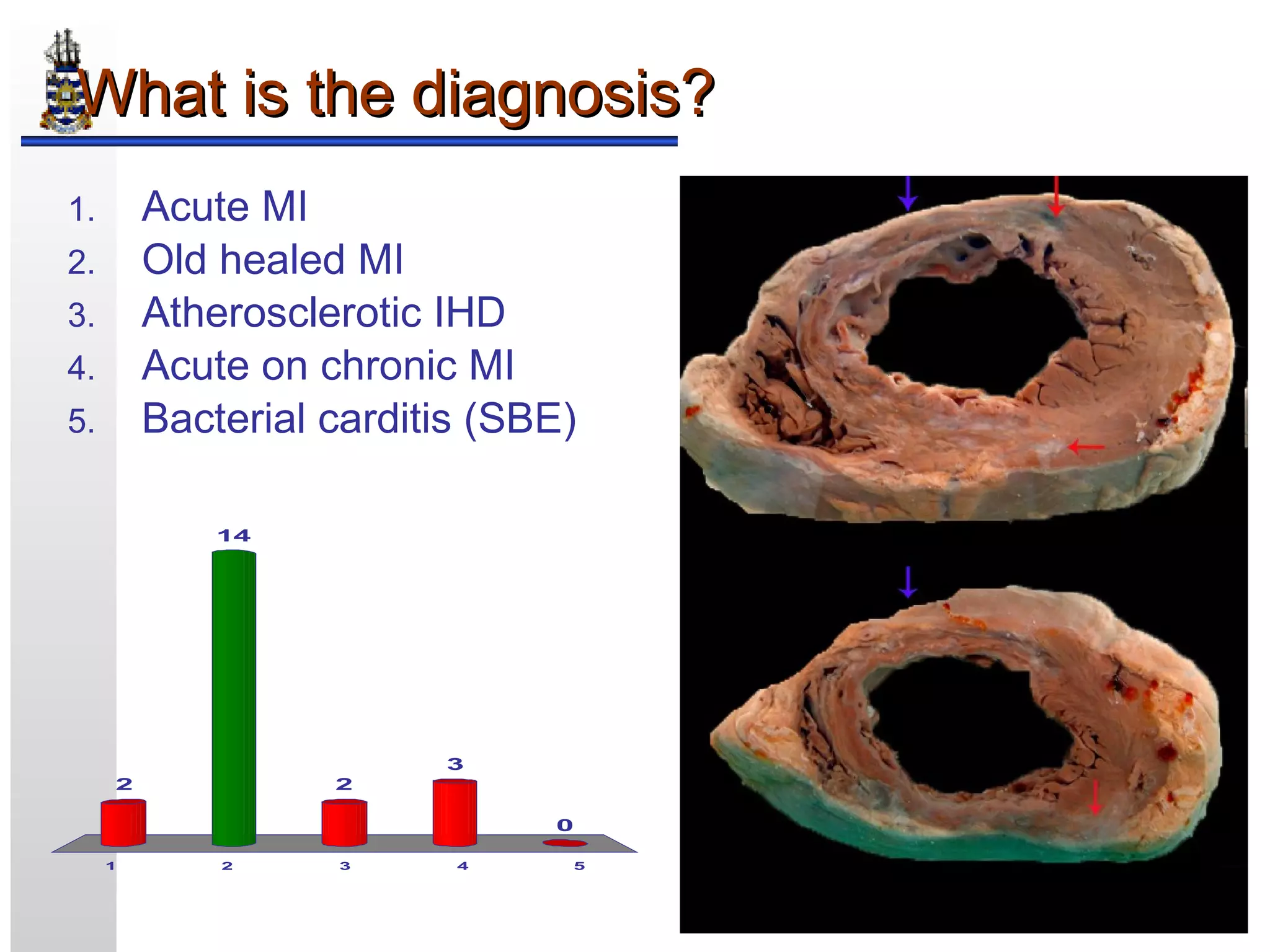 Pathology of Myocardial Infarction | PPT