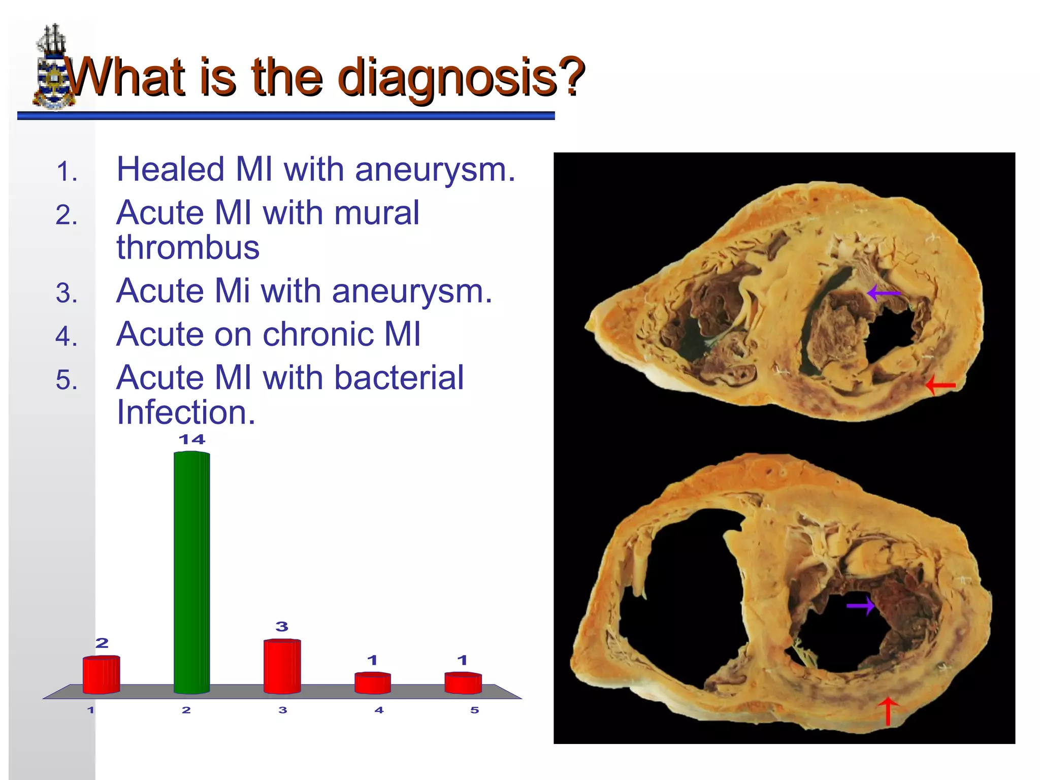 Pathology of Myocardial Infarction | PPT