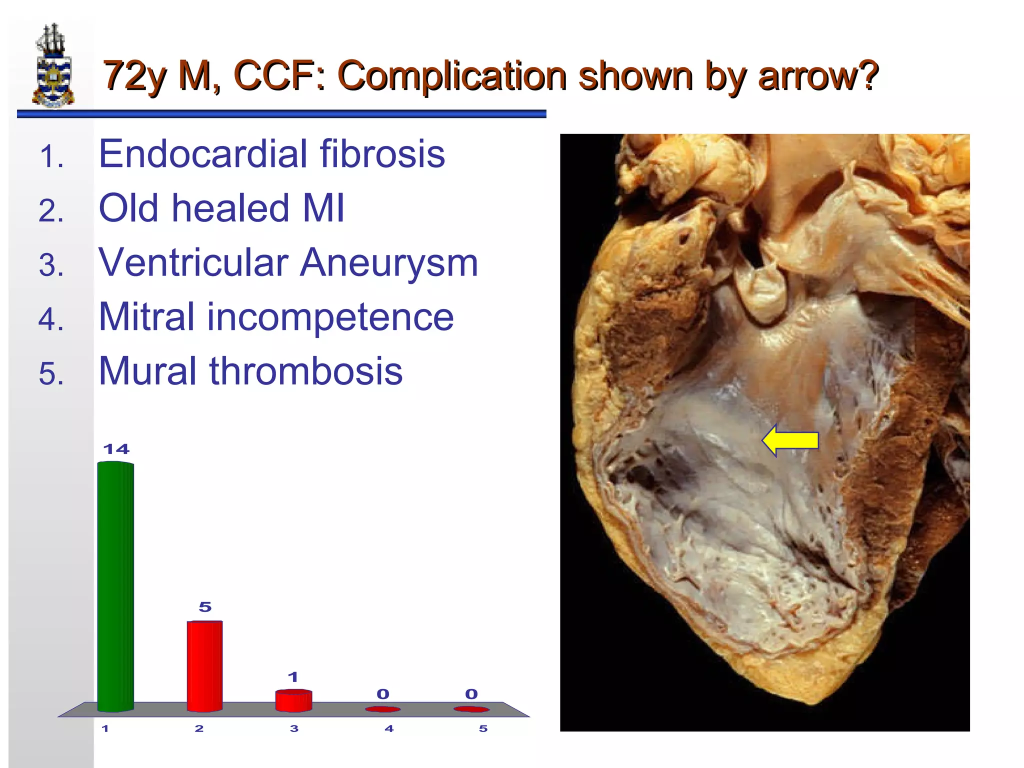 Pathology of Myocardial Infarction | PPT
