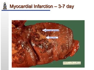 Pathology of Myocardial Infarction | PPT