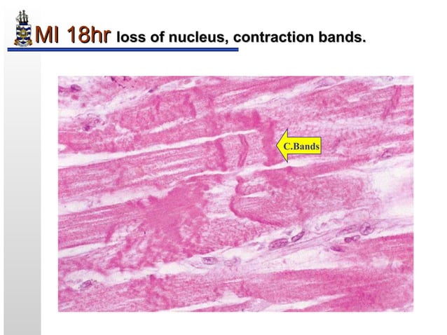 Pathology of Myocardial Infarction | PPT
