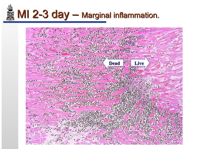 Pathology of Myocardial Infarction | PPT