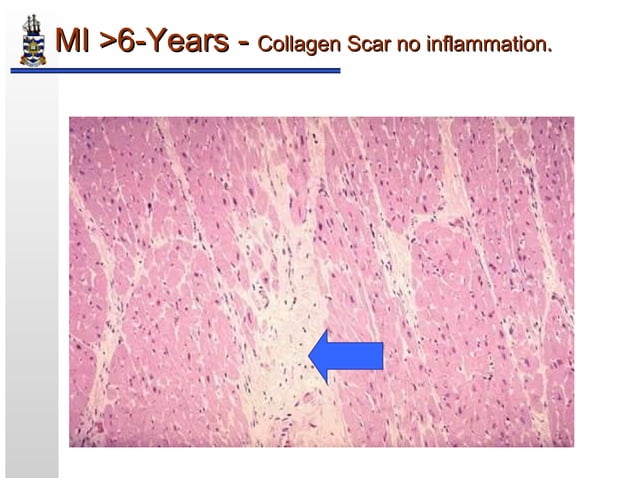 Pathology of Myocardial Infarction | PPT