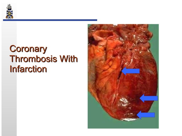 Pathology of Myocardial Infarction | PPT