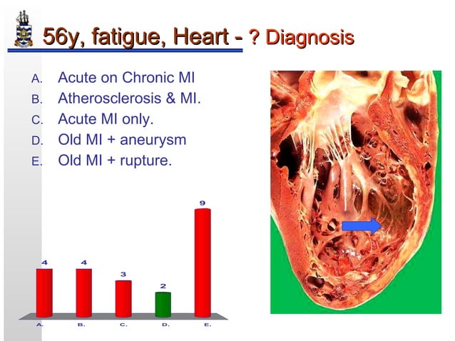 Pathology of Myocardial Infarction | PPT