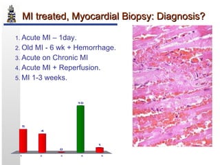 Pathology of Myocardial Infarction | PPT