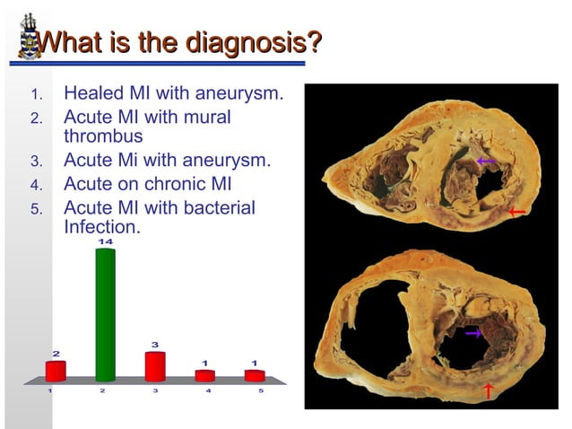 Pathology of Myocardial Infarction | PPT