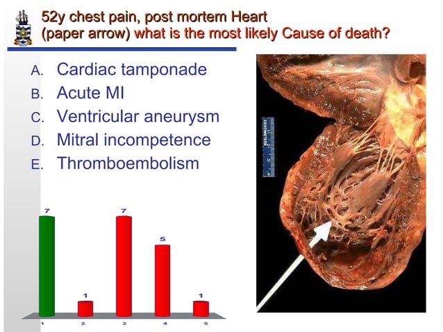 Pathology of Myocardial Infarction | PPT