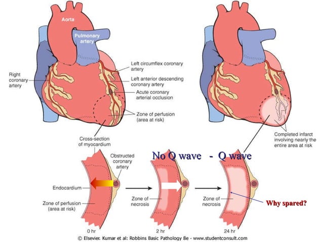 Pathology of Myocardial Infarction | PPT
