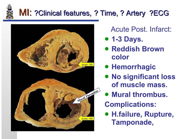 Pathology of Myocardial Infarction