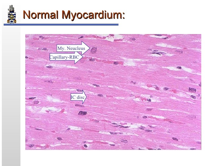 Pathology of Myocardial Infarction