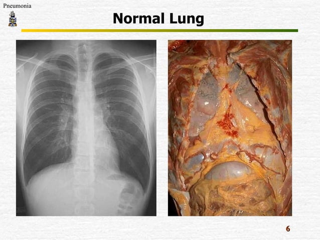Pathology of Pneumonia | PPT