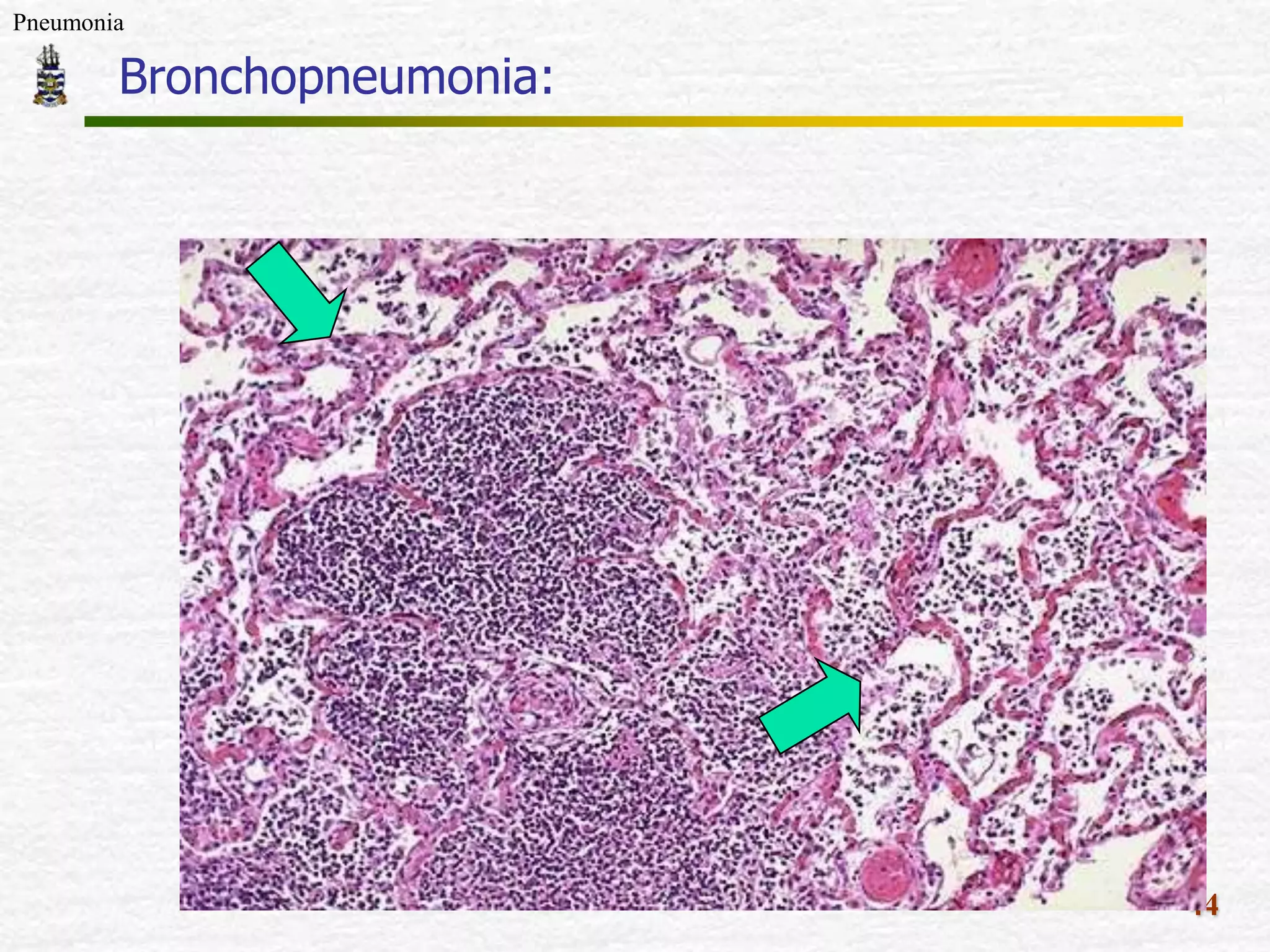 Pathology of Pneumonia | PPTX