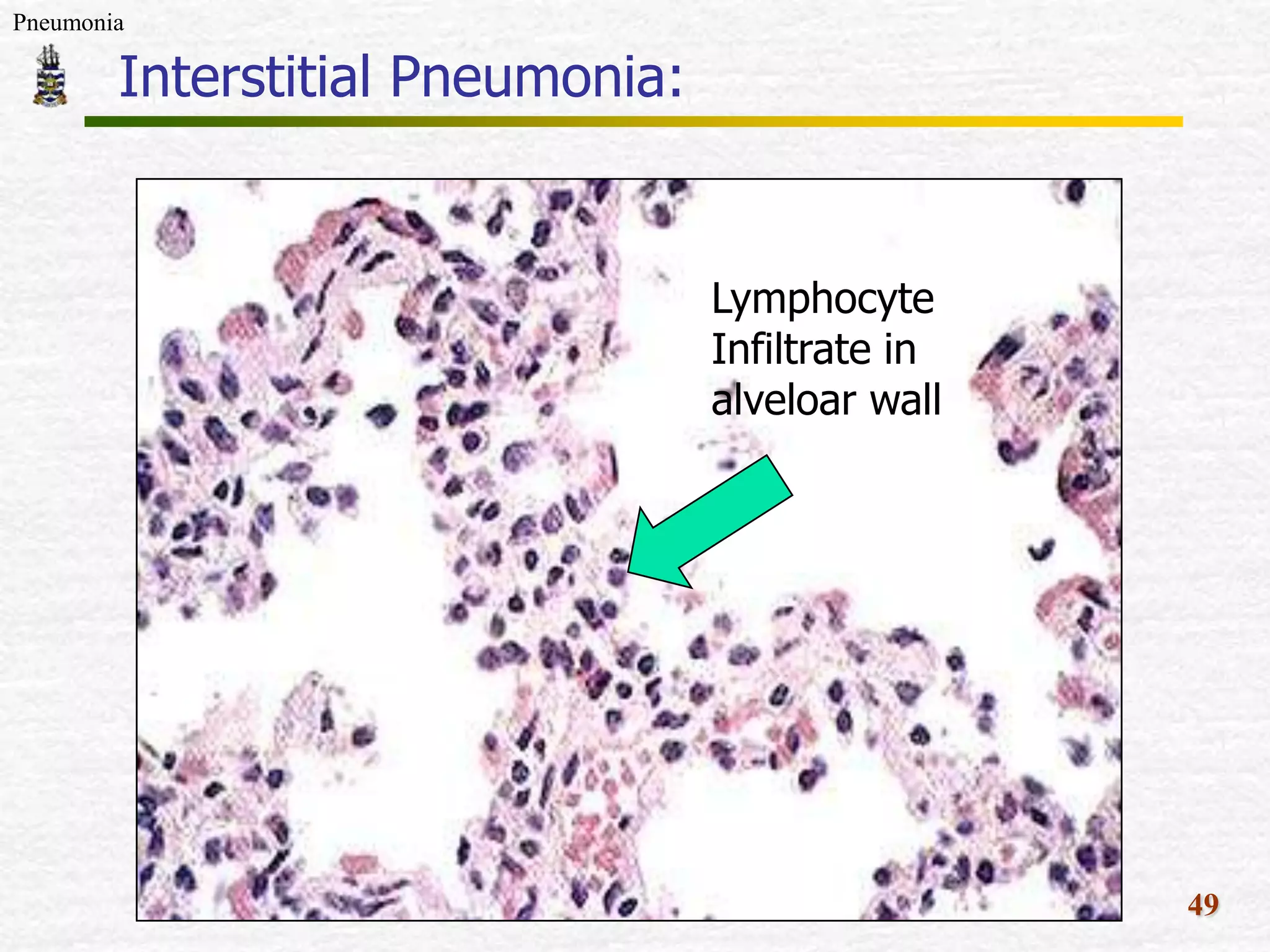 Pathology of Pneumonia | PPTX