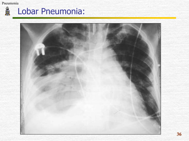 Pathology of Pneumonia | PPTX