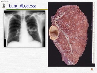 Pathology of Pneumonia | PPTX