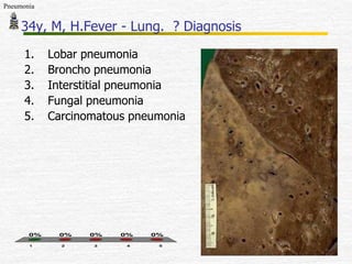 Pathology of Pneumonia | PPTX