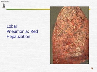 Lobar Pneumonia Stages