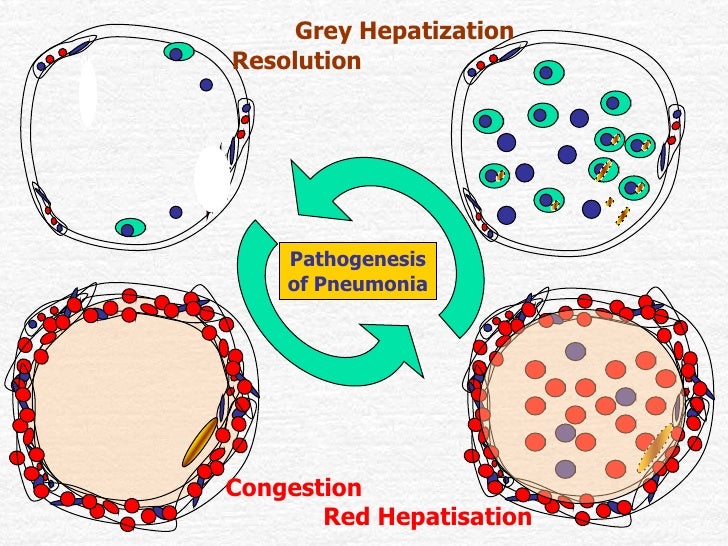 Pathology of Pneumonia