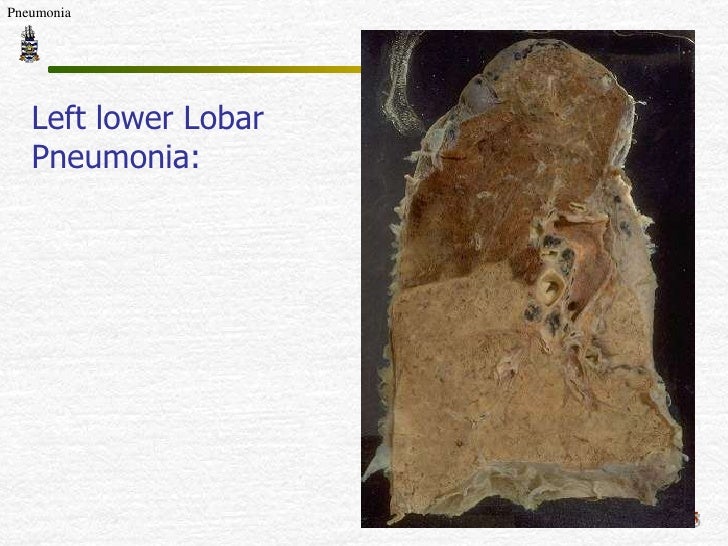 Lobar Pneumonia Gross