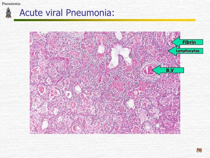 Pathology of Pneumonia