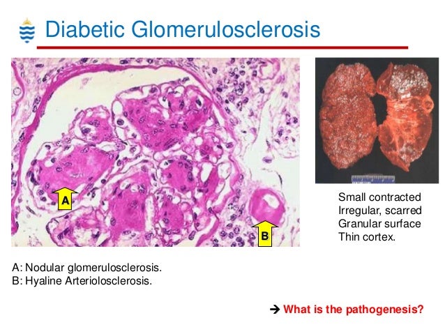 Pathology of Diabetes