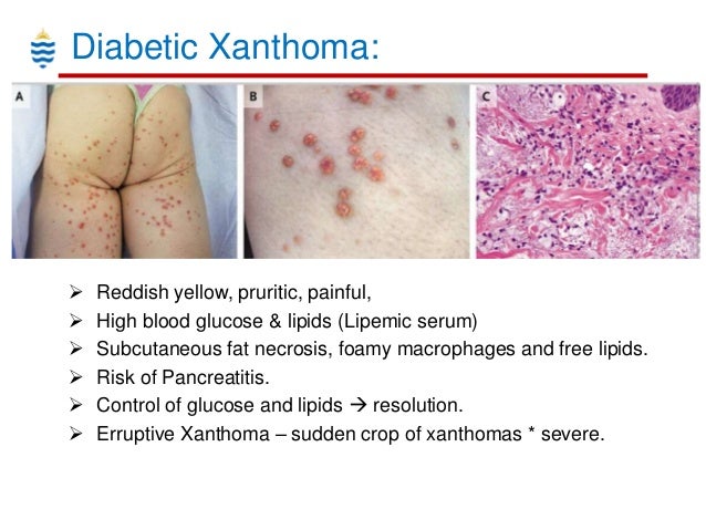 Xanthomatosis Diabetes