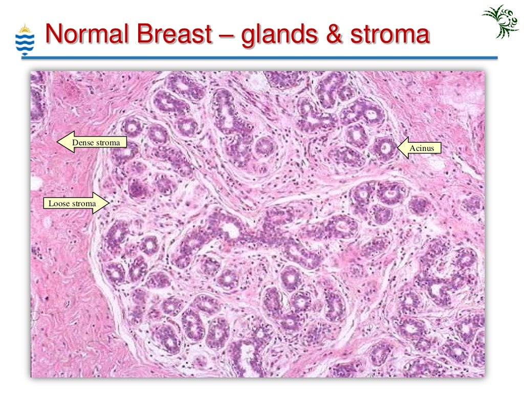 Breast Pathology Lecture - 2013