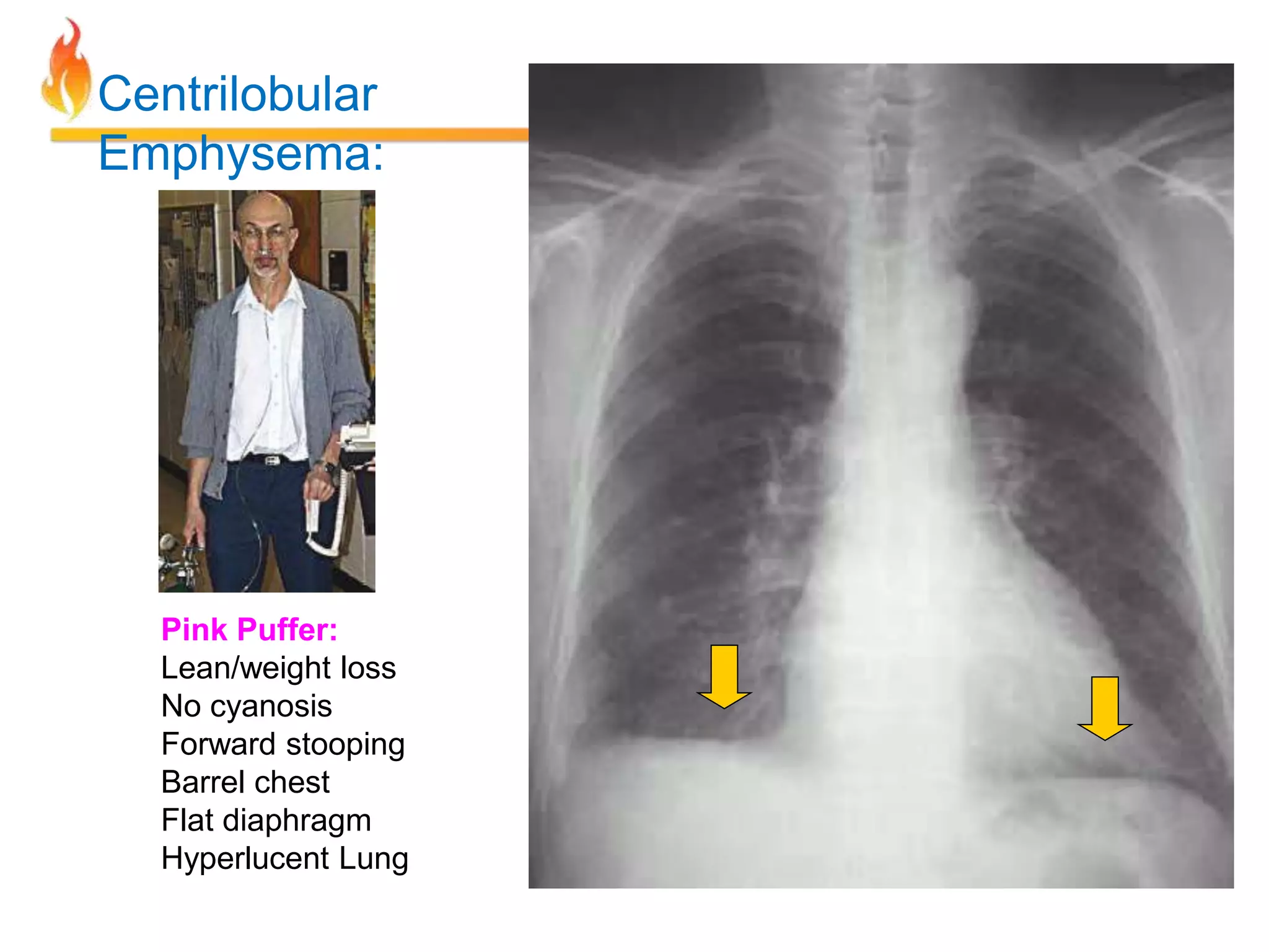Pathology of COPD | PPTX