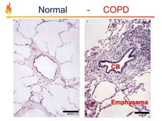 Chronic Bronchitis Histology