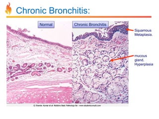 Chronic Bronchitis Pathology
