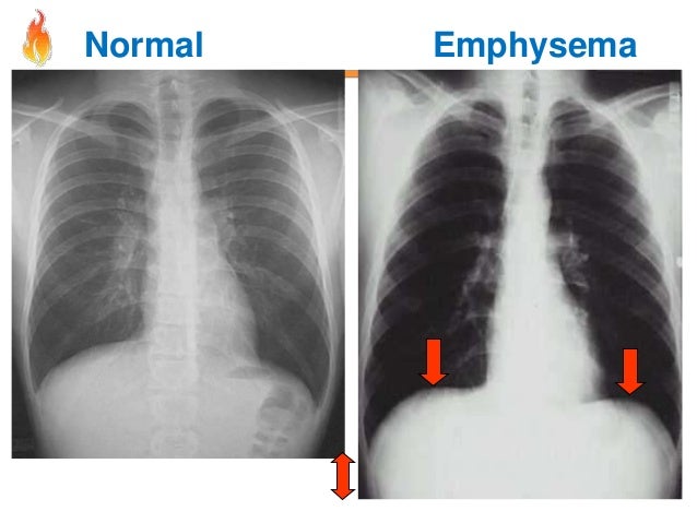 Chest xray normal vs abnormal - freeloadsinnovation