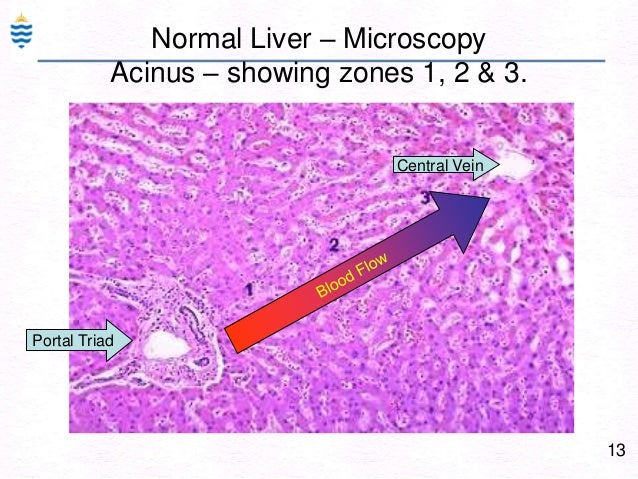 Pathology of Hepatitis - Lecture