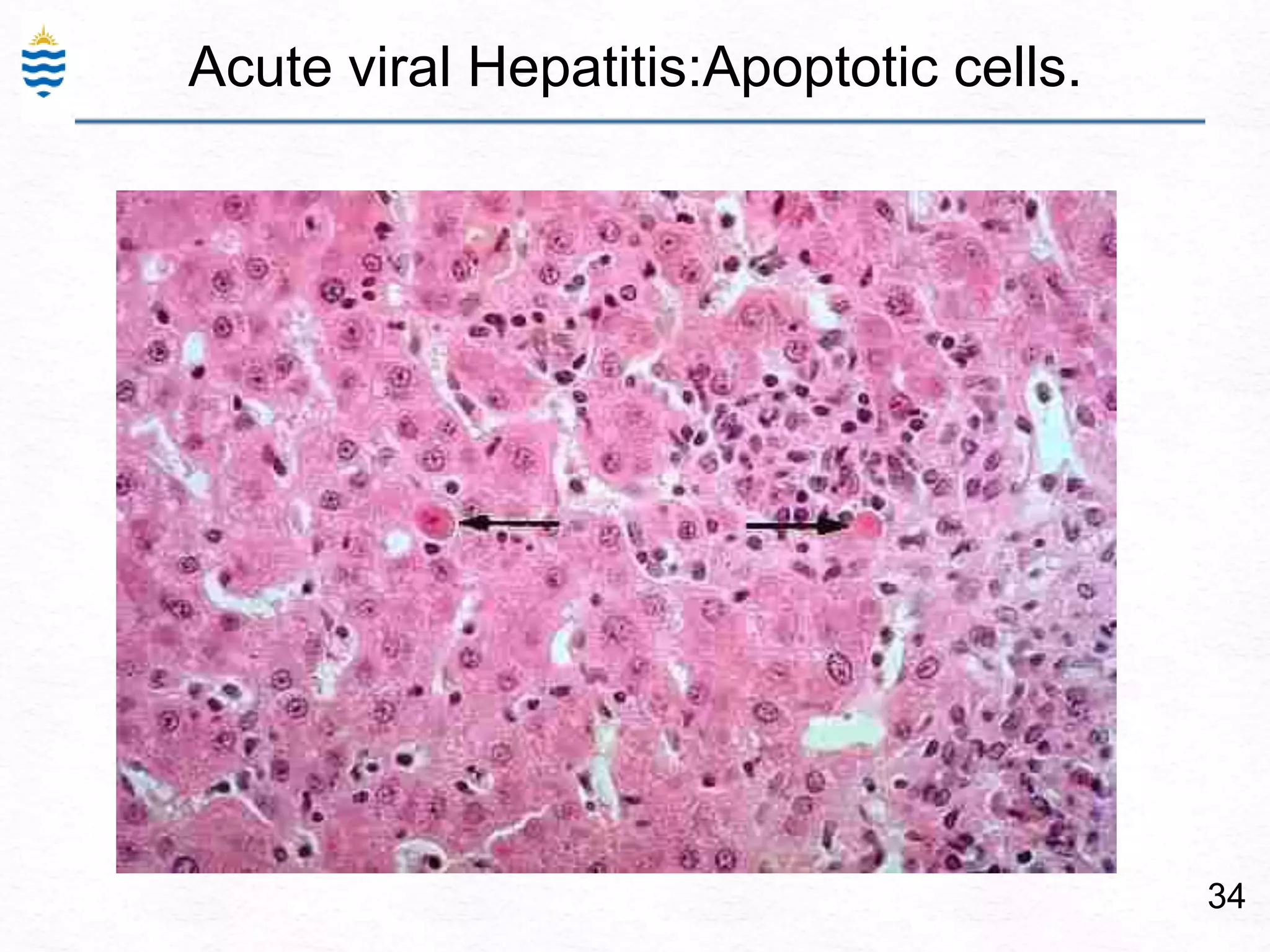 Pathology of Hepatitis | PPTX