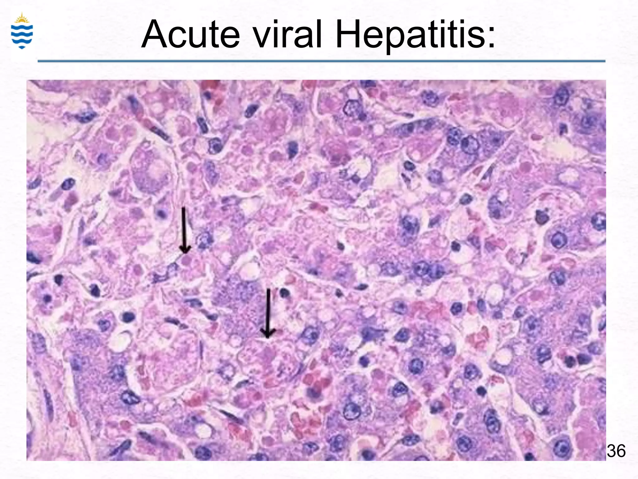 Pathology of Hepatitis | PPTX