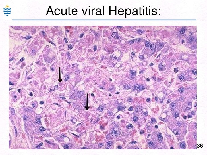 Pathology of Hepatitis