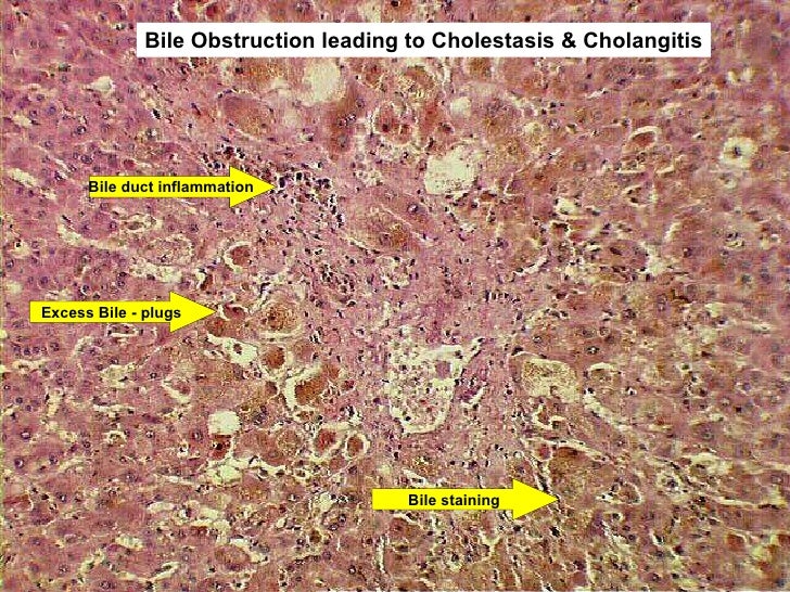 Disorders of Biliary System
