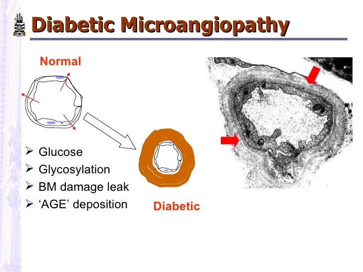 Pathology of Diabetes