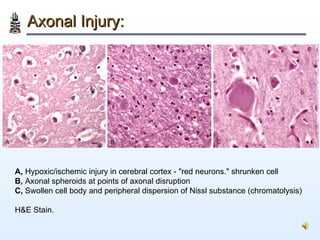 Diffuse Axonal Injury Histology
