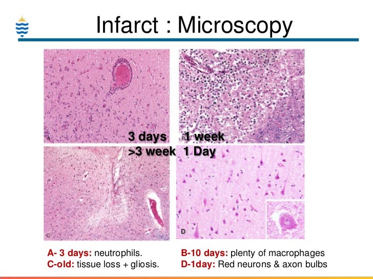 Pathology of Stroke & CVA