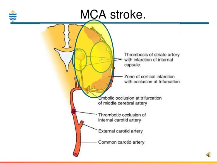 Pathology Of Stroke CVA Pathology Of Stroke CVA