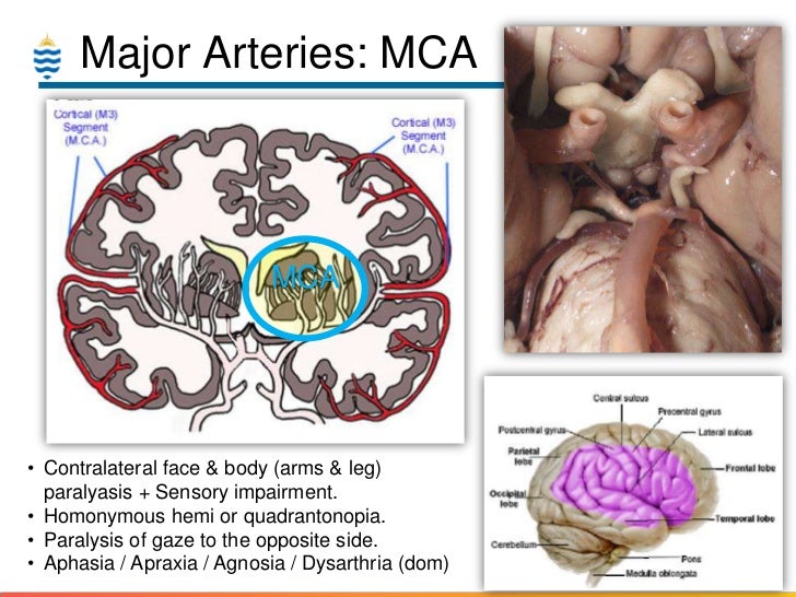 Pathology of Stroke & CVA