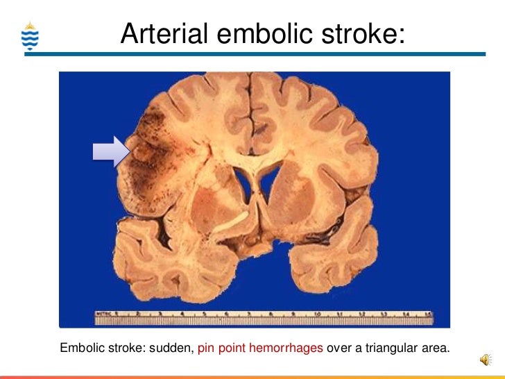 Pathology of Stroke & CVA