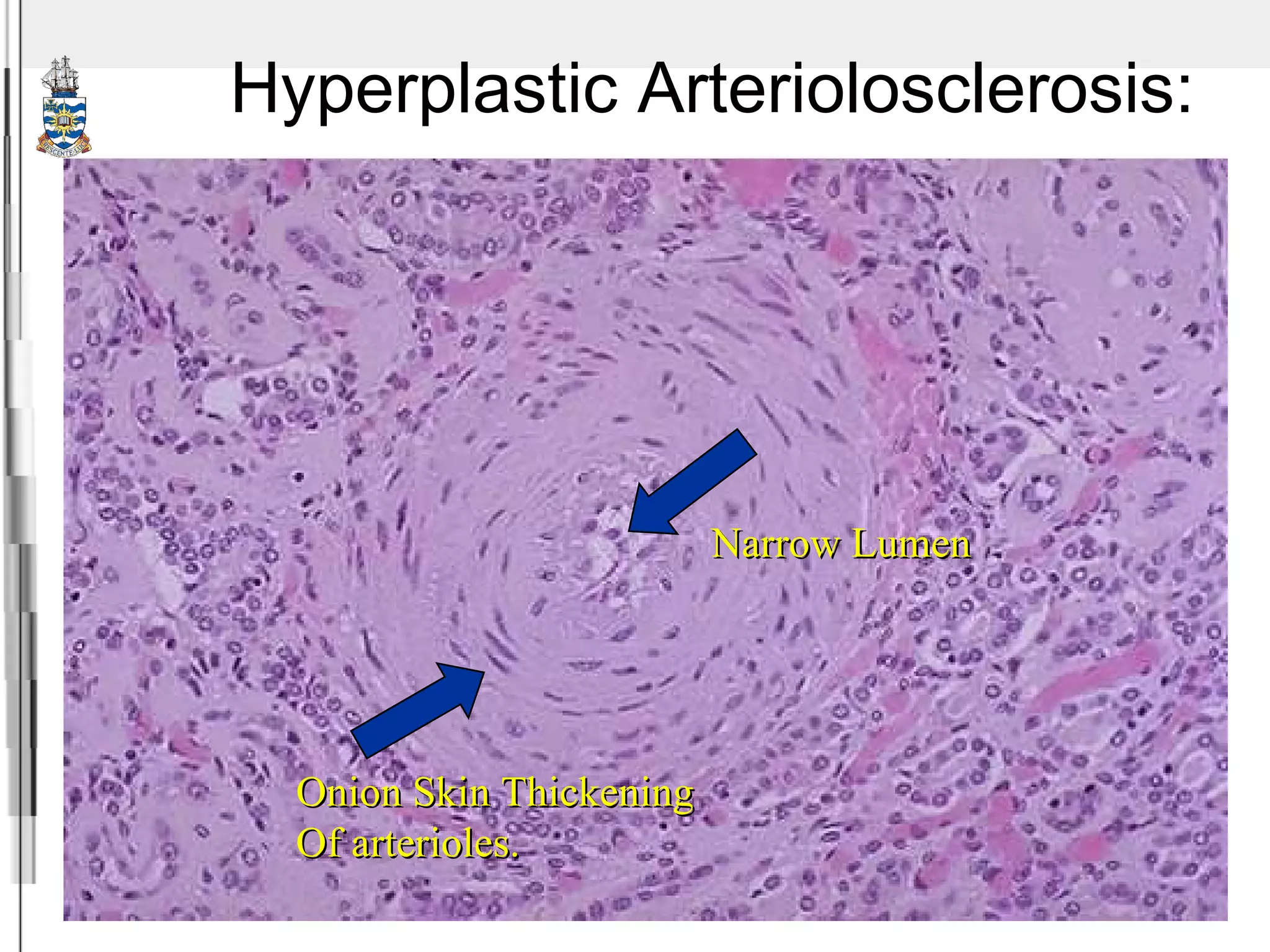 Pathology of Hypertension | PPT