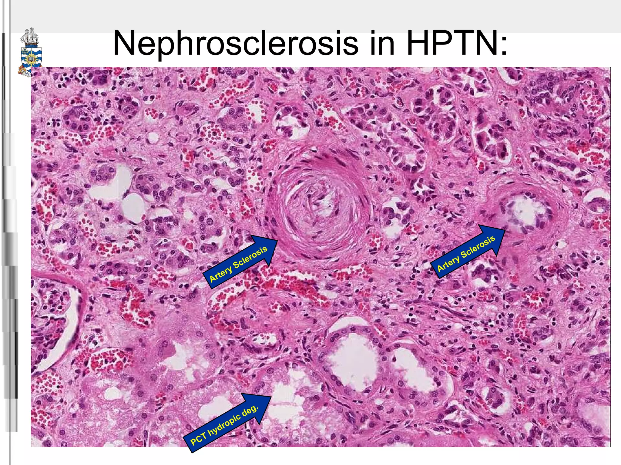 Pathology of Hypertension | PPT