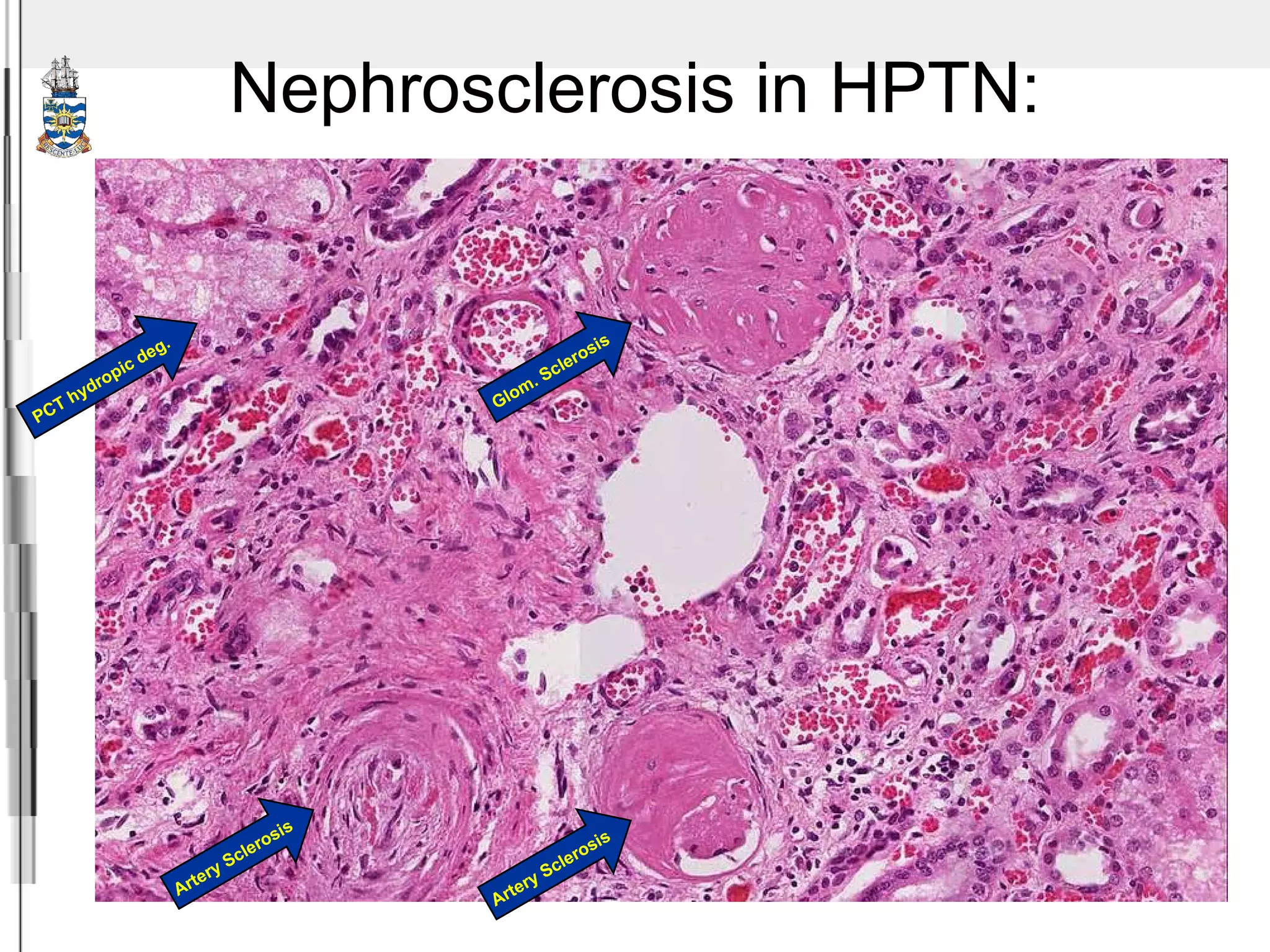Pathology of Hypertension | PPT