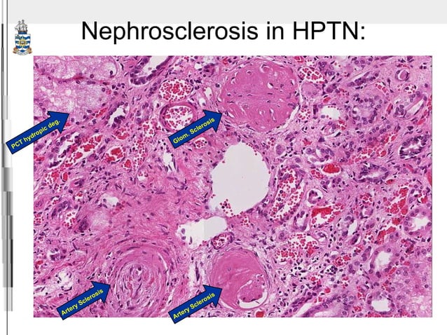 Pathology of Hypertension | PPT