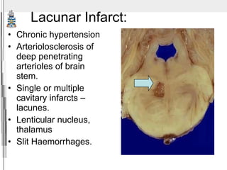 Pathology of Hypertension | PPT